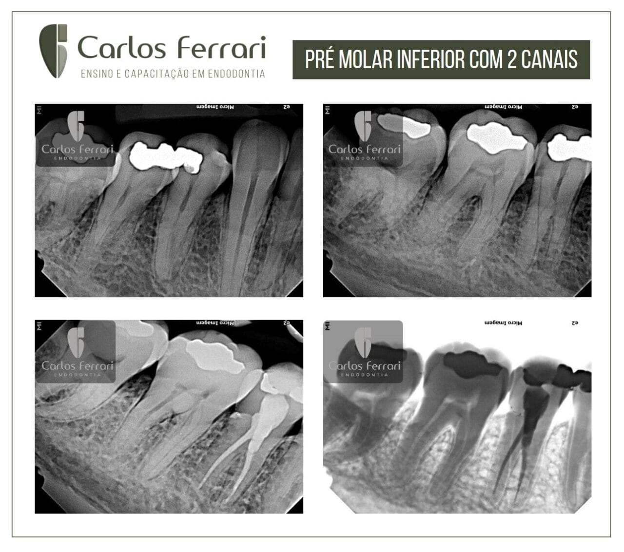 Pré-molar inferior. Tratamento de dente 45 com dois canais.
