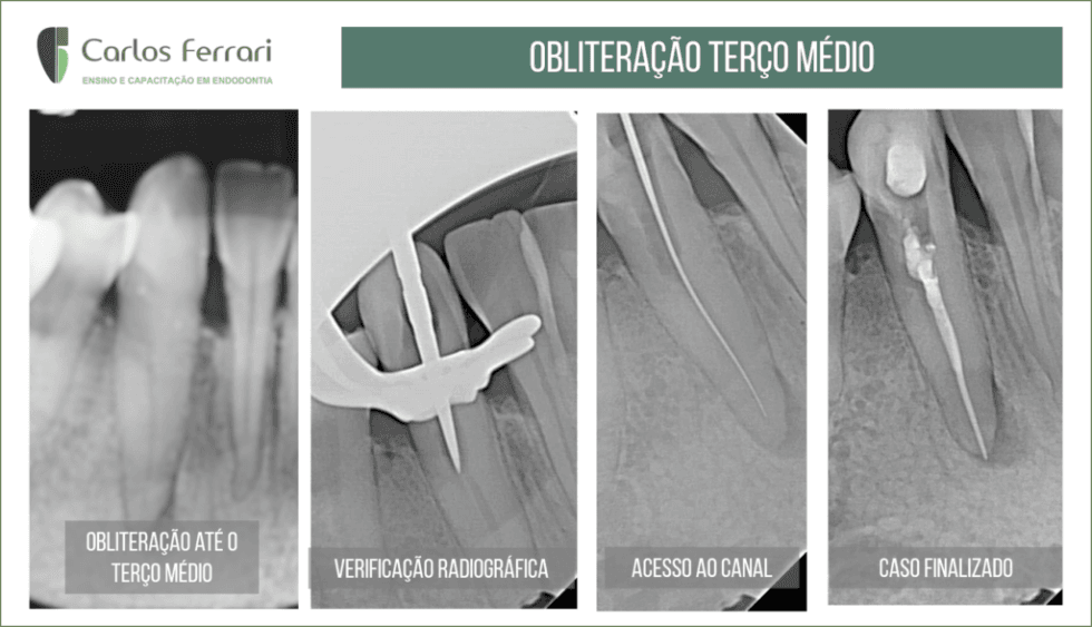calcificação do canal radicular