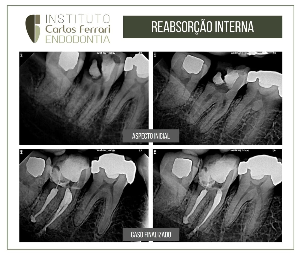 Reabsorção radicular interna em molar inferior.